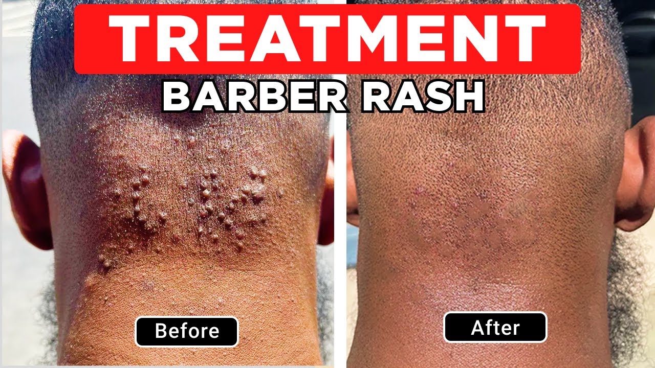 razor bump – ChoiceMart NG