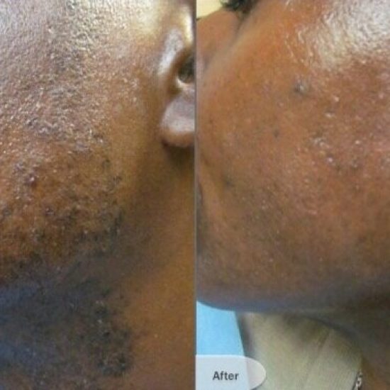 razor bump – ChoiceMart NG